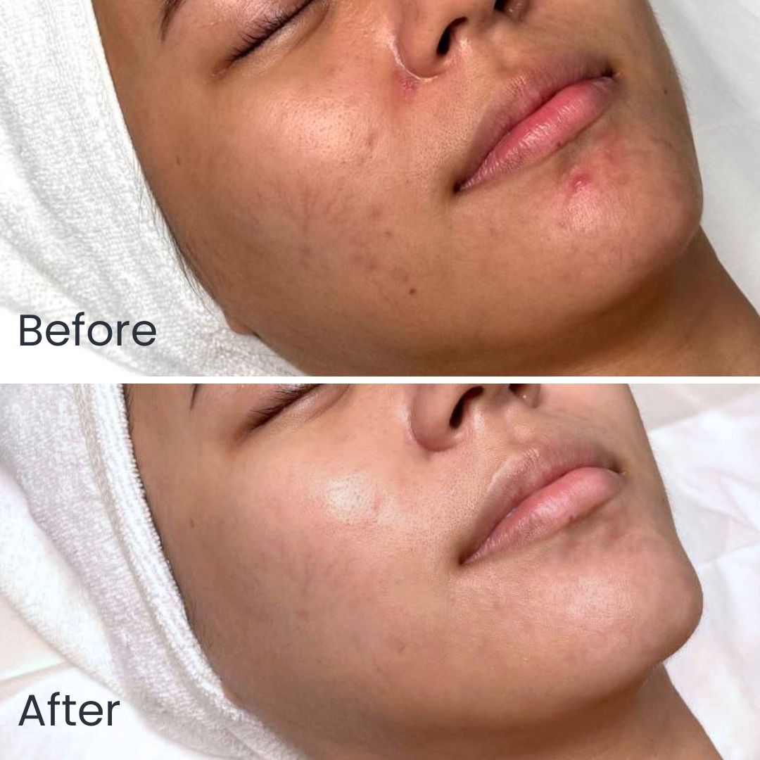 Luminfusion Therapy – AsterSpring Singapore